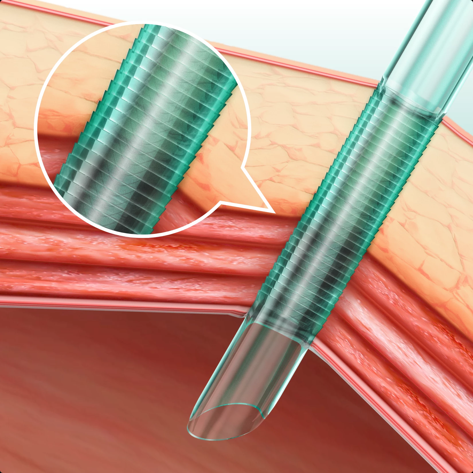 Advantages of Trocar Solution. - Surgsci Medical Ltd.