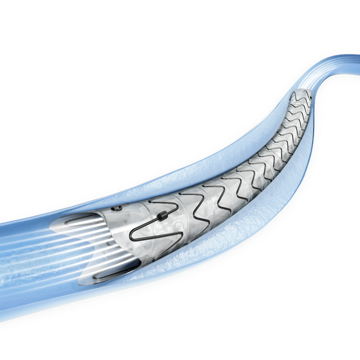 Ureteral Covered Stent System - Surgsci Medical Ltd.